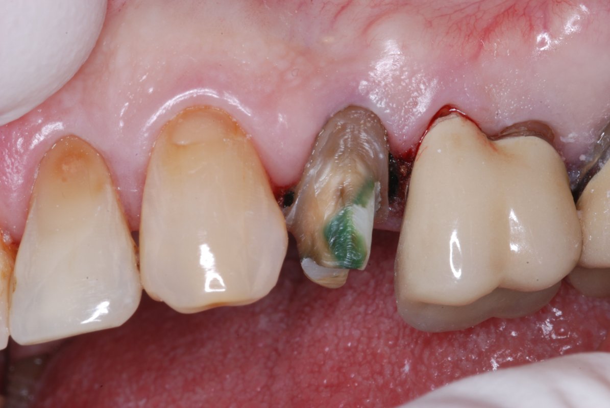 blog-in-house-dental-studio-40-w-elm-st-greenwich-connecticut-06830-tel-1-203-769-1622