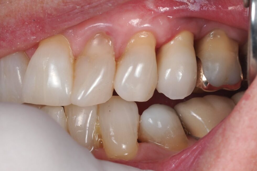 Case 11, Lingual set screw retained implant crown #13 | In-House Dental ...