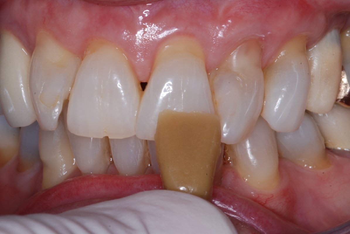 Case 11, Lingual set screw retained implant crown #13 | In-House Dental ...