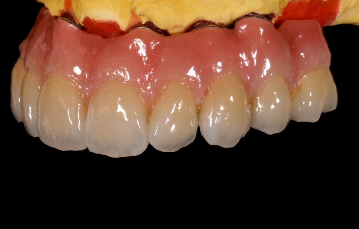 Case 9, Cement Retained Implant Supported FPD On Titanium Abutments ...