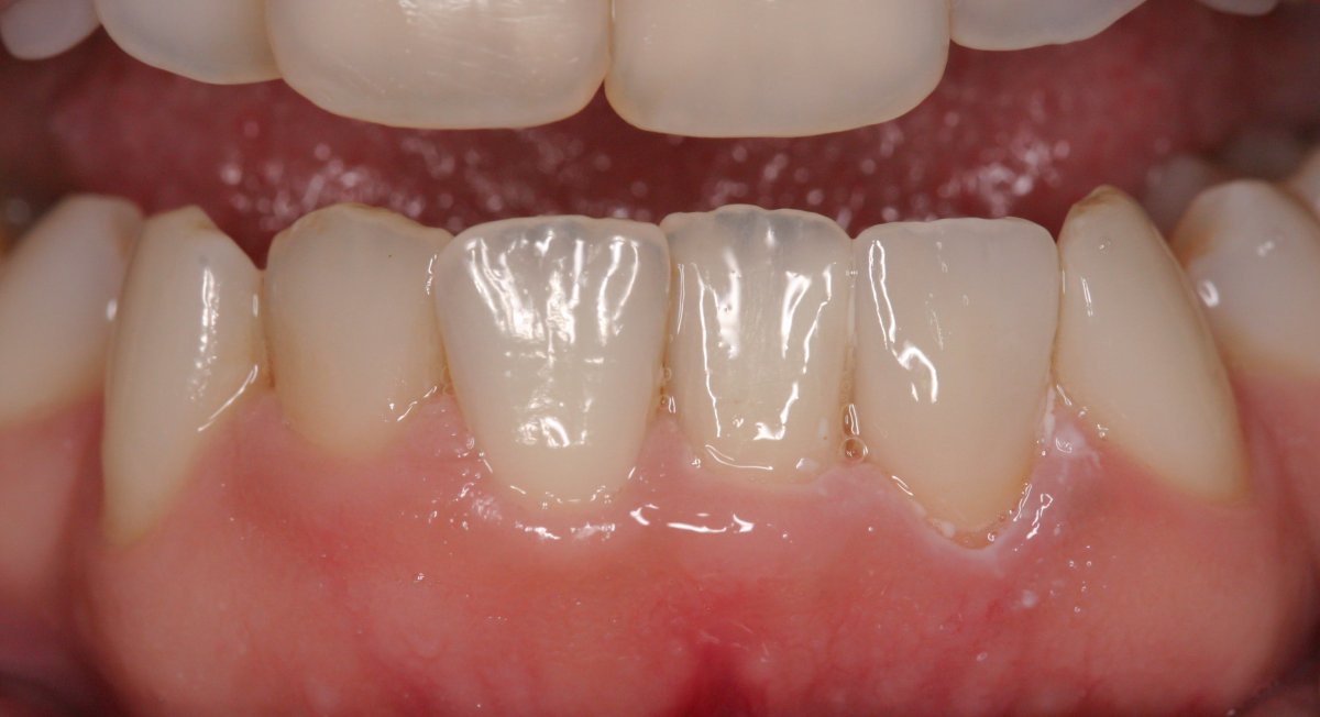 Case 15, e.max Layer Crown | In-House Dental Studio