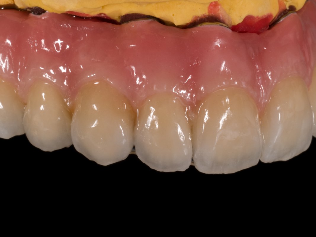 Case 9, Cement Retained Implant Supported FPD On Titanium Abutments ...