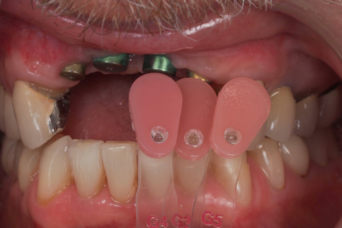 Case 12, Implant Supported Bridge 7-11 | In-House Dental Studio