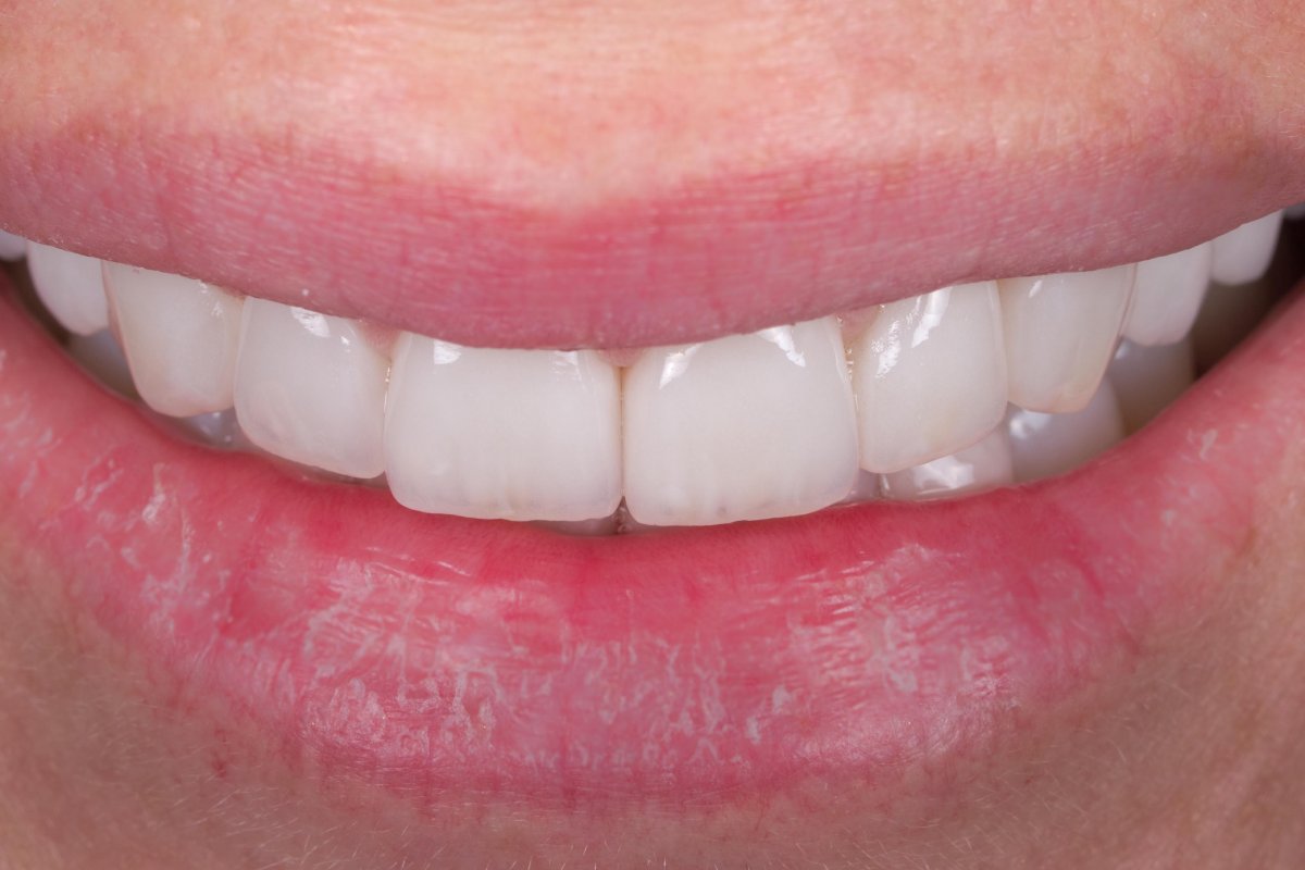 Case 16, Anterior Esthetic Makeover with Crowns, Veneers and Invisalign ...
