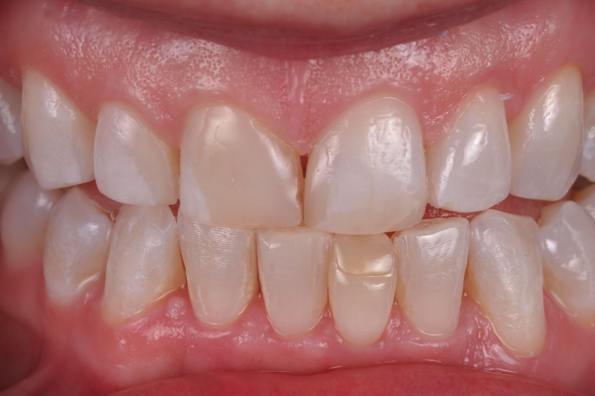 Case 16, Anterior Esthetic Makeover with Crowns, Veneers and Invisalign ...