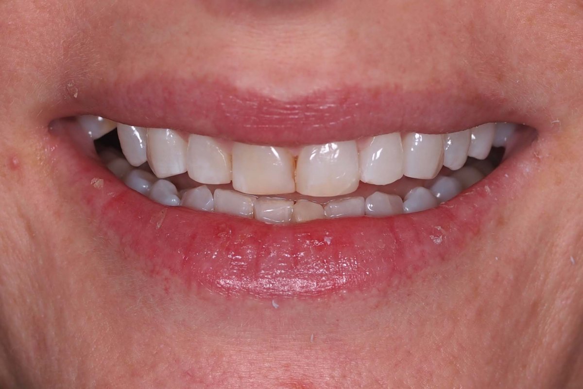 Case 16, Anterior Esthetic Makeover with Crowns, Veneers and Invisalign ...