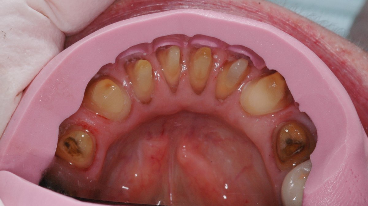Zirconia Crown Prep