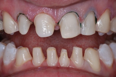 Case 16, Anterior Esthetic Makeover with Crowns, Veneers and Invisalign ...